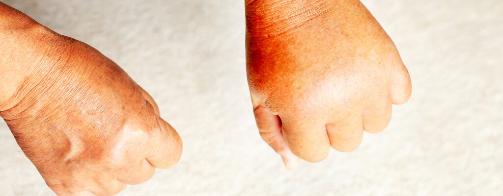 Are You Swollen? It Could Be Hereditary Angioedema (HAE)